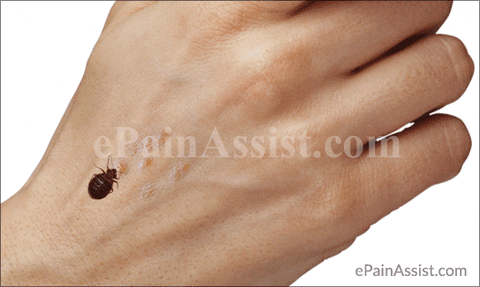 Bedbug Bite GIF by ePainAssist - Find & Share on GIPHY