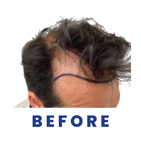 Hair Restoration Center GIFs on GIPHY - Be Animated