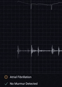 Atrial Fibrillation Animation Gif