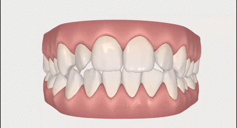 invisalign | Tag | PrimoGIF